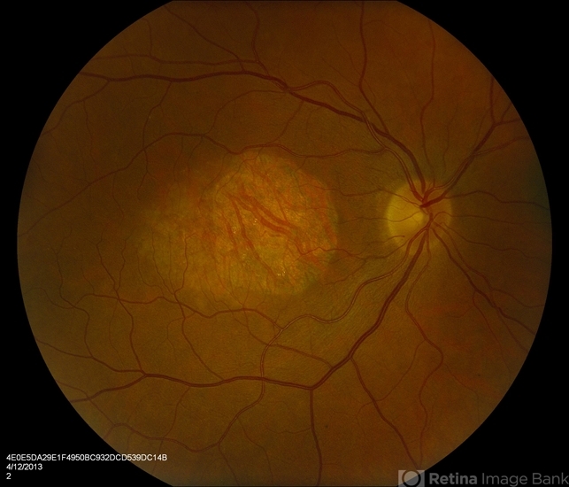 Central Areolar Choroidal Dystrophy (CACD): A full Overview