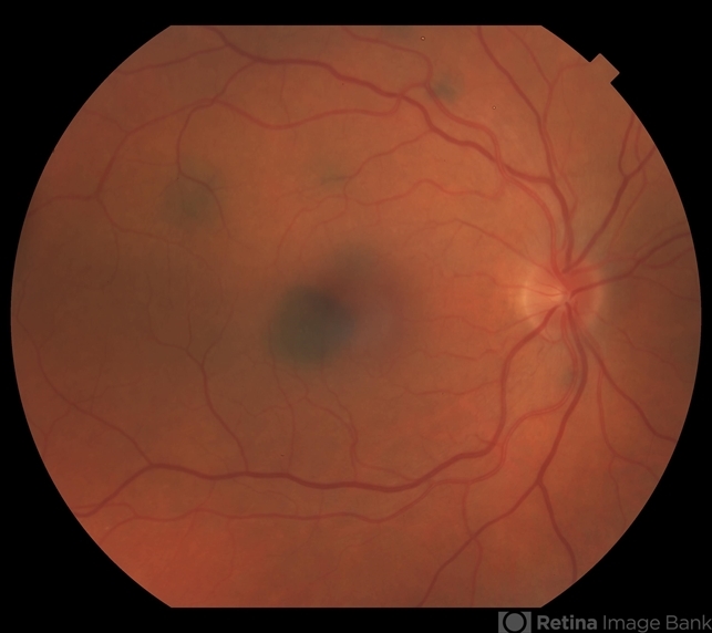 Bilateral Diffuse Uveal Melanocytic Proliferation (BDUMP ...