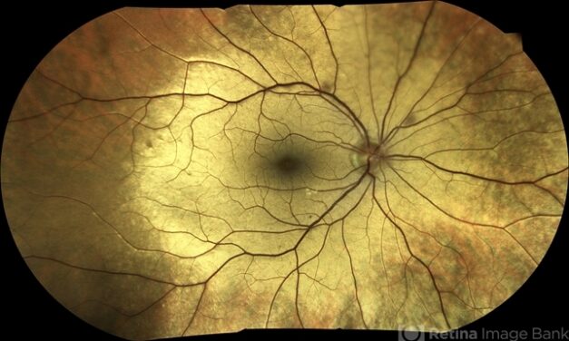 Oguchi disease: Degenerative Retinal Disease - Ophthalmology Education
