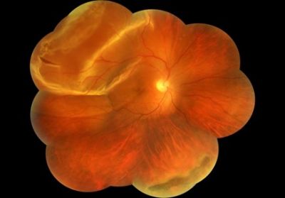 Macula-on Rhegmatogenous Retinal Detachment - Ophthalmology Education