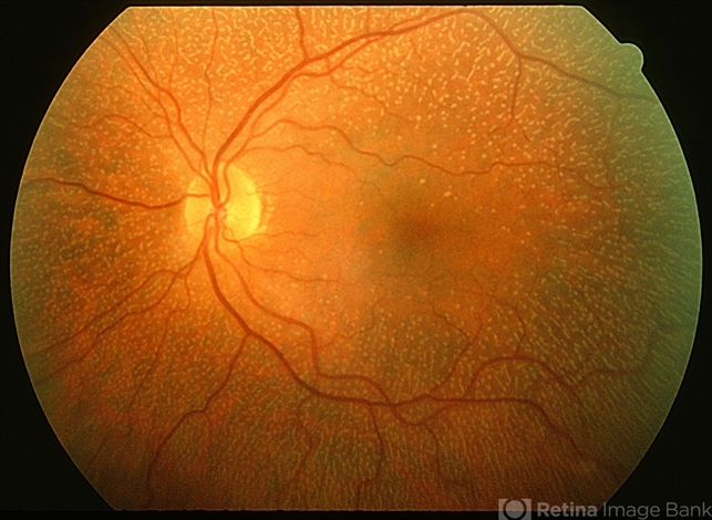 Fundus albipunctatus (FA): a night blindness cause - Ophthalmology ...
