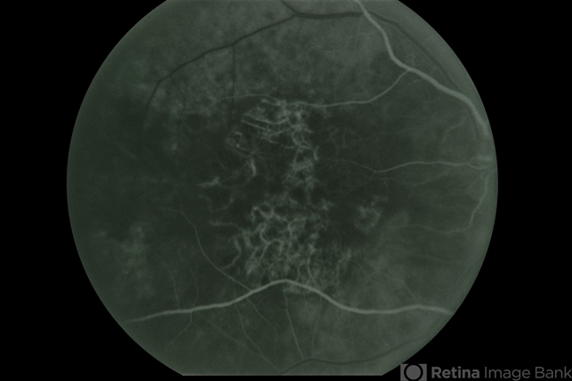 Central Areolar Choroidal Dystrophy (CACD): A full Overview
