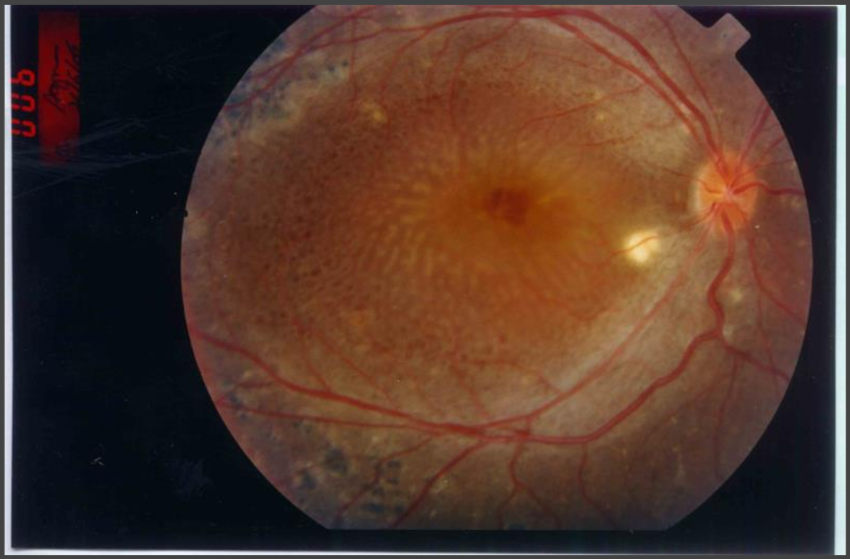 Goldmann-Favre syndrome: A full study - Ophthalmology Education