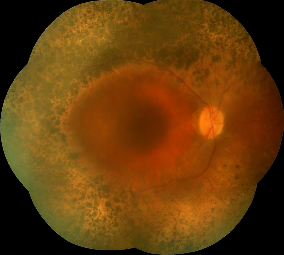 Goldmann-Favre syndrome: A full study - Ophthalmology Education
