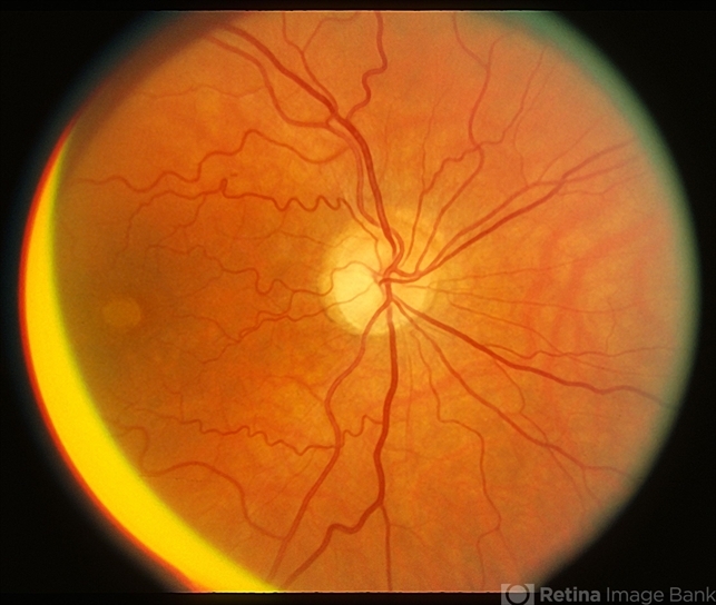 Vitelliform macular dystrophy (VMD): A comprehensive review ...