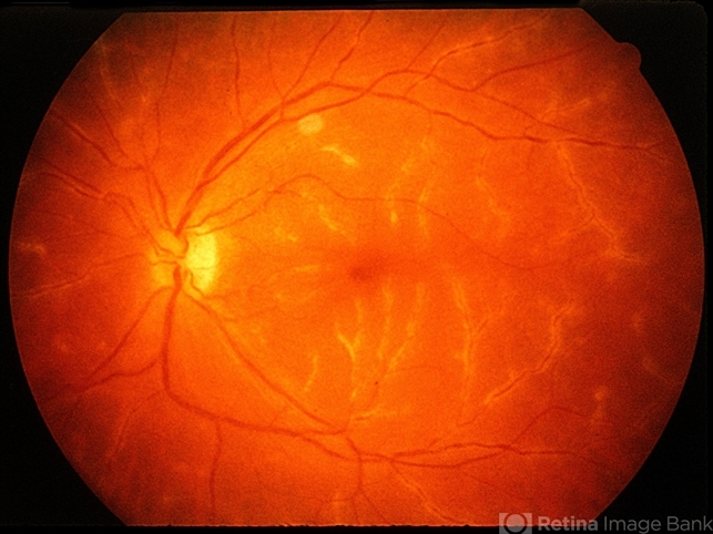 Frosted branch angiitis: a rare form of retinal vasculitis ...