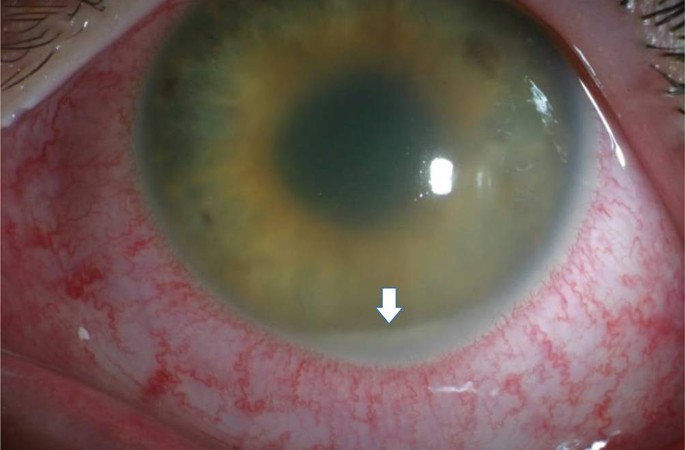 Acute Anterior Uveitis (AAU) - Ophthalmology Education