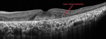 Outer Retinal Tubulation: Marker or Misdiagnosis? - Ophthalmology Education