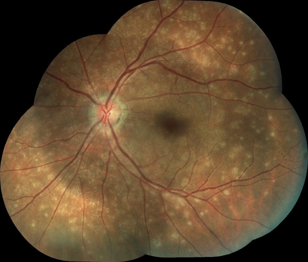 White Dot Syndromes: Are You Dealing with MEWDS, APMPPE, or Something Else?