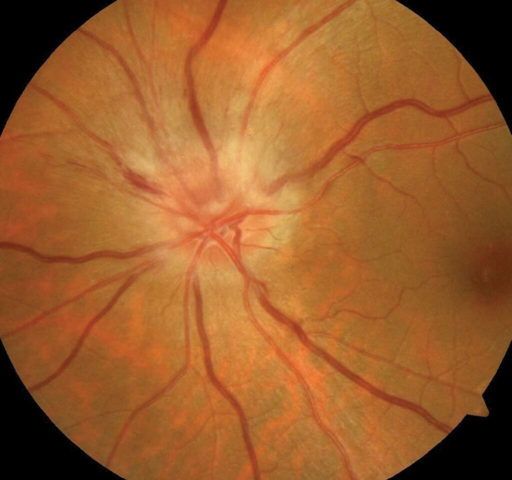 Non-Arteritic Anterior Ischemic Optic Neuropathy (NAION ...