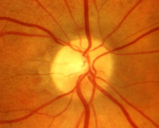 Non-Arteritic Anterior Ischemic Optic Neuropathy (NAION ...