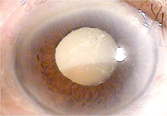 Phacolytic Glaucoma: Recognition and Management - Ophthalmology Education