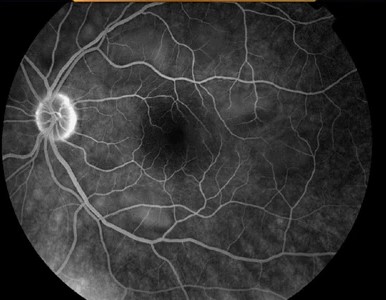 Paraneoplastic Retinopathy: When Cancer Affects the Retina ...