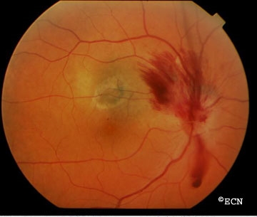 Radiation-induced Optic Neuropathy: Clinical challenges - Ophthalmology ...