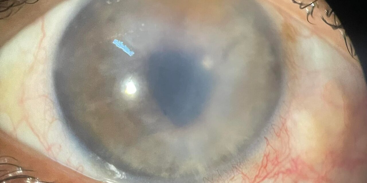 Pseudophakic Bullous Keratopathy (PBK): Causes and management ...