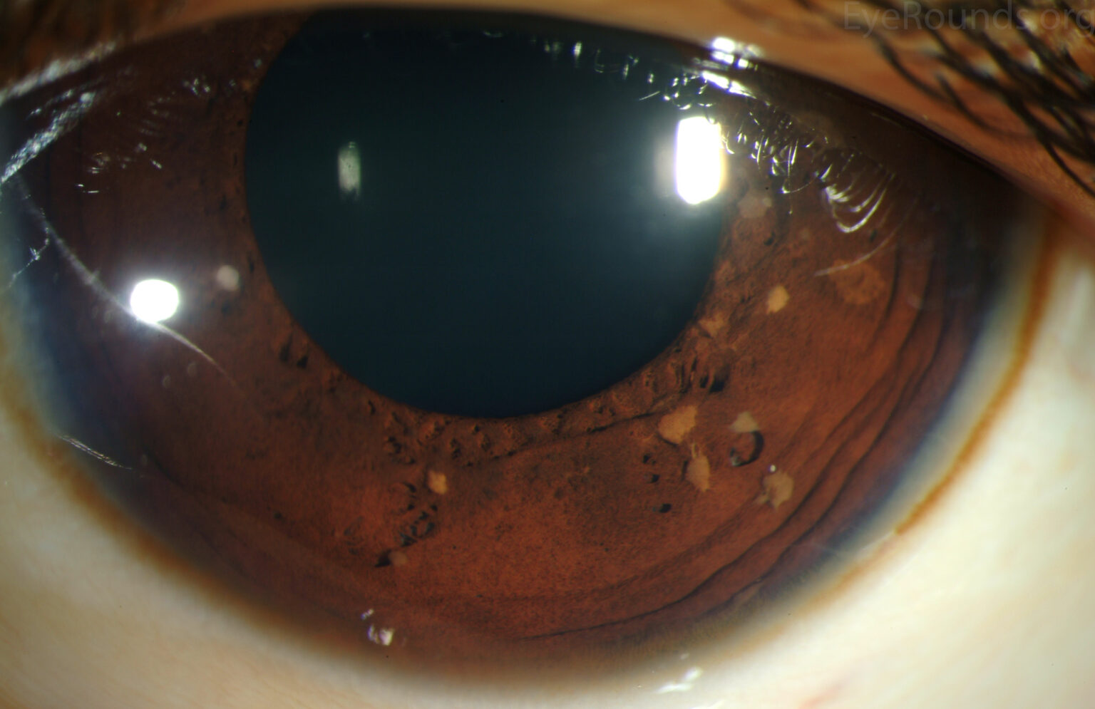 Iris Hamartomas Explained - Ophthalmology Education
