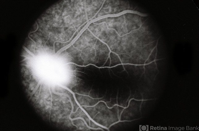 Retinal Capillary Hemangioblastoma: Clinical Features and Management