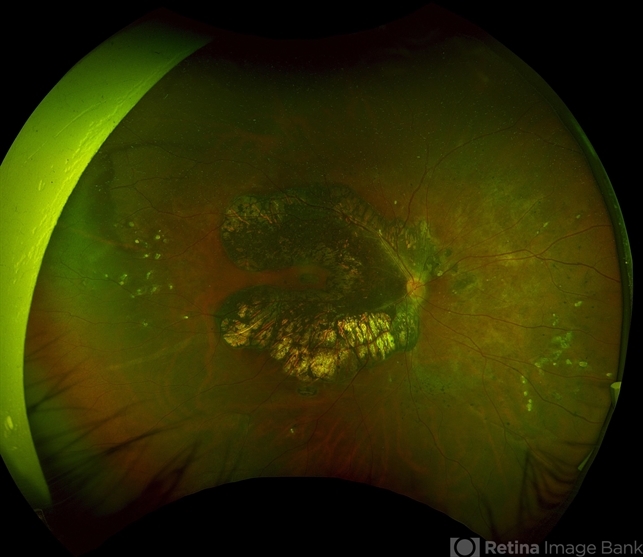 Pigmented Paravenous Retinochoroidal Atrophy: A Rare Retinal Disorder