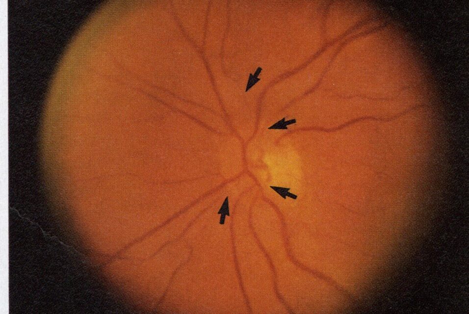 Idiopathic Retinal Vasospasm: A Transient Ischemic Phenomenon ...
