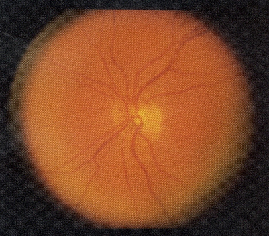 Idiopathic Retinal Vasospasm: A Transient Ischemic Phenomenon ...